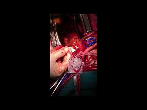Surgical repair of chronic post-traumatic left ventricular psudoaneurysm
