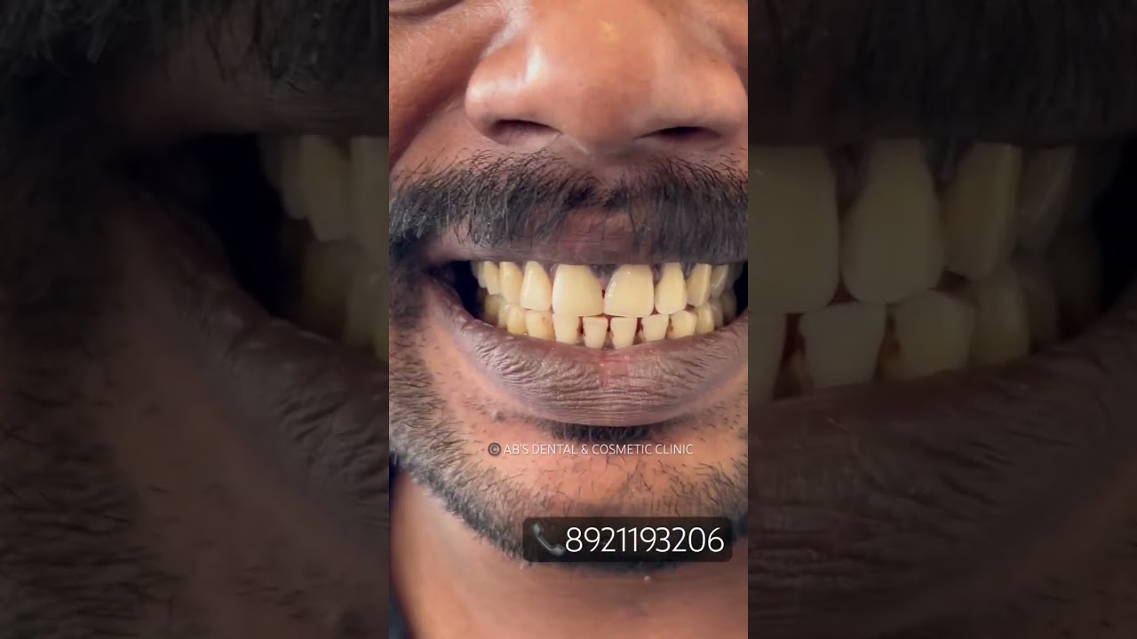 Smile correction(gap closure) at MALA,Thrissur 📞8921193206#smilecorrection #teethgapmakeover#kerala