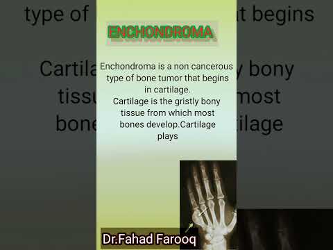 Enchondroma #drfahad#enchondroma #physiotherapy
