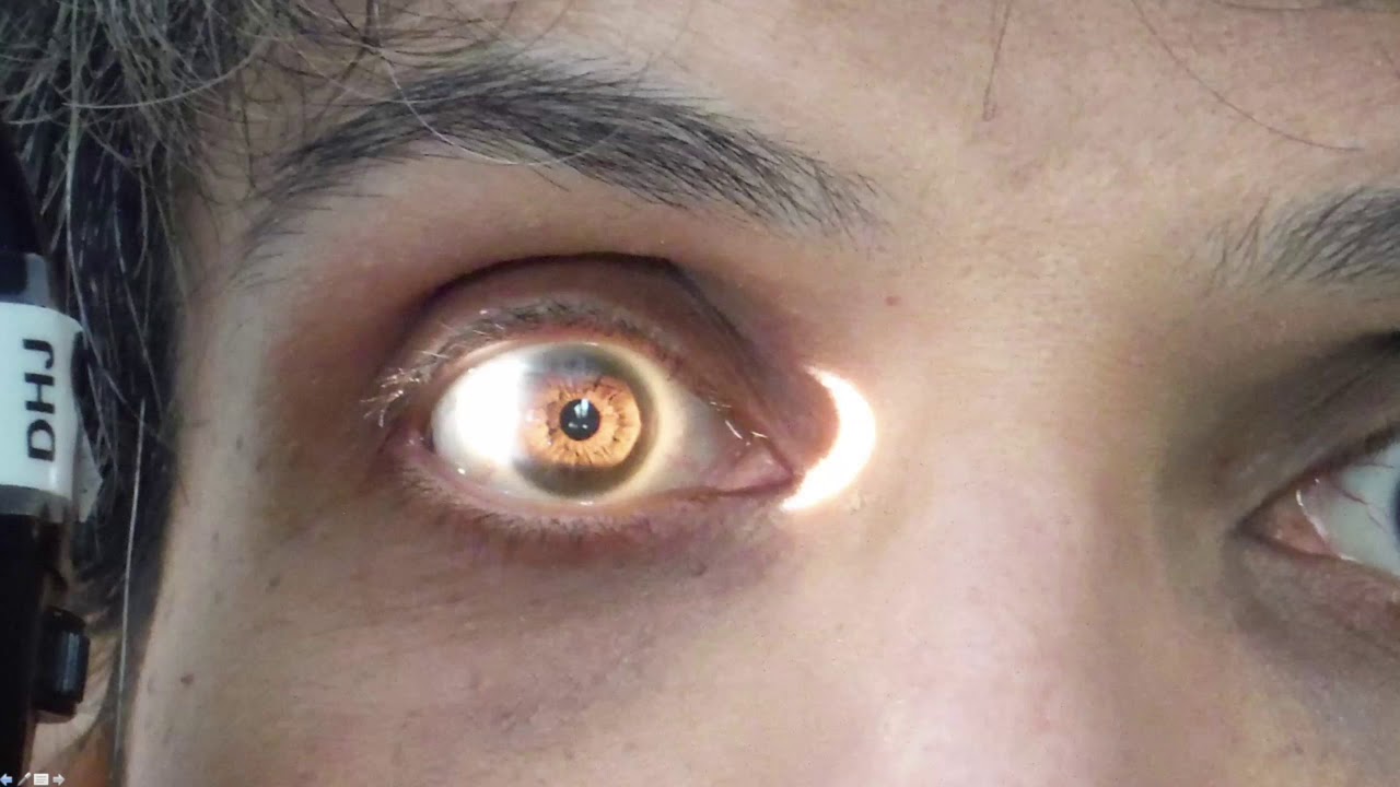 7. How to Assess the Anterior Chamber