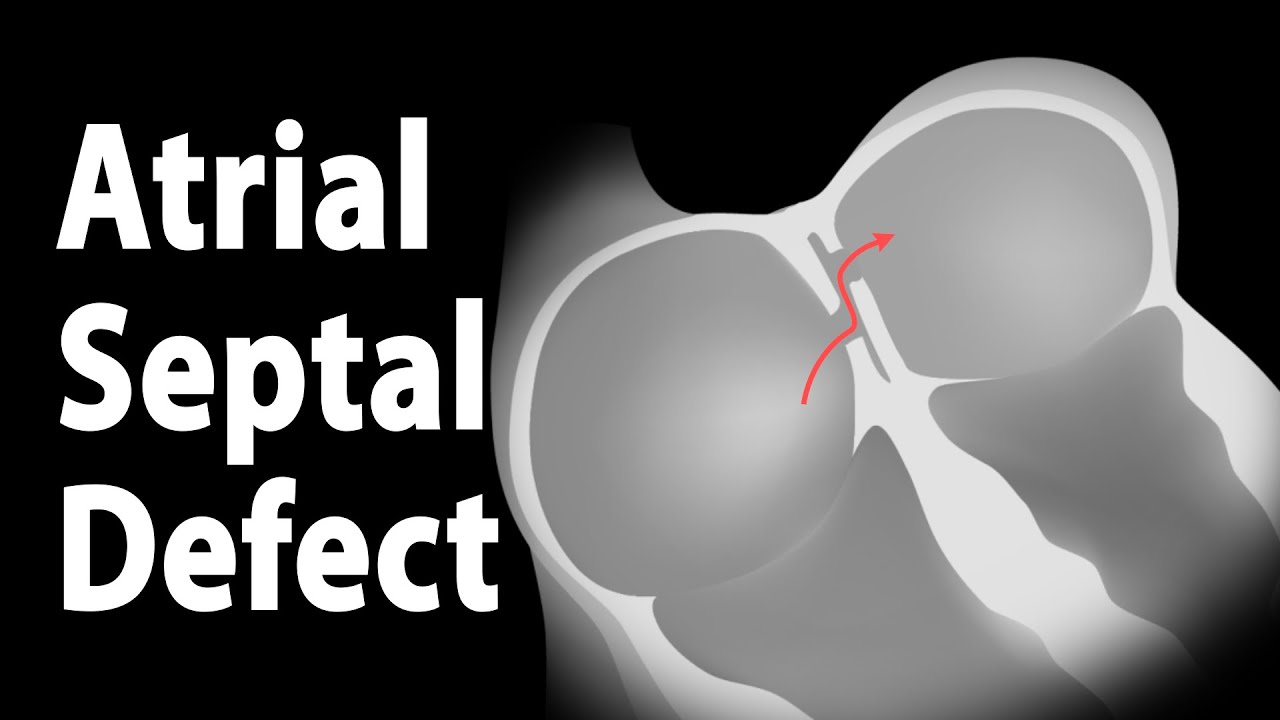 Atrial Septal Defect (ASD), Animation.