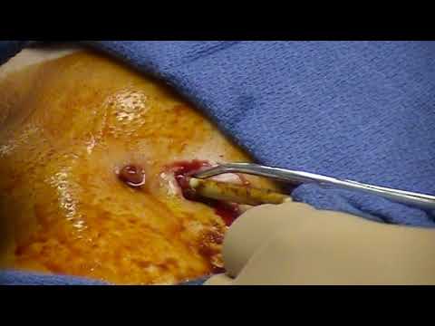 Interventional Nephrology; Real Time Training
