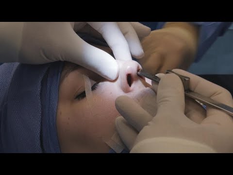 Inside Woman’s Nose Job Surgery