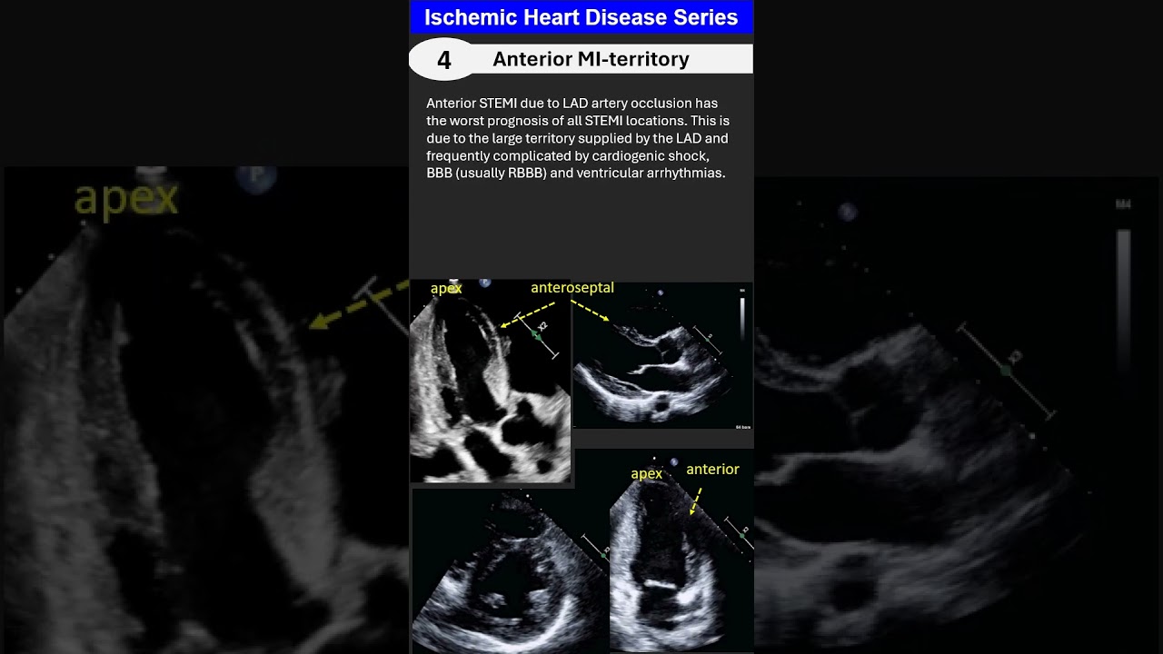 Ischemic Heart Disease 4: Anterior Myocardial Infarction