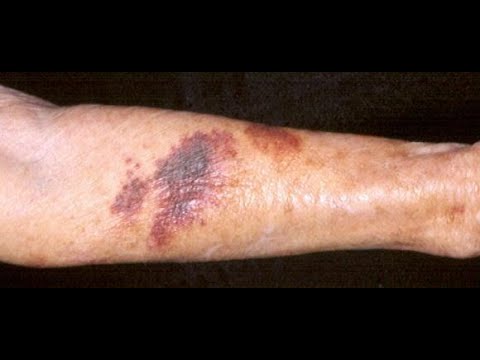 ACTINIC (SENILE) PURPURA Causes, Treatment: What is Senile (Solar) Purpura?
