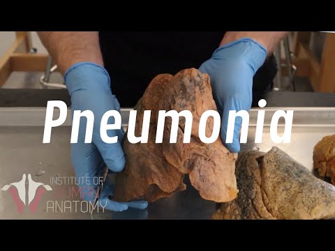 What Is Pneumonia?