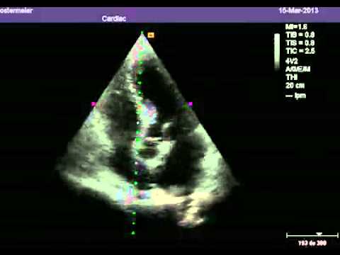 Líquido libre en fosa de Morrison - Ecografía Clínica - FESEMI