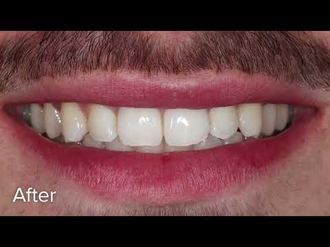 Teeth Whitening at MAC Dental