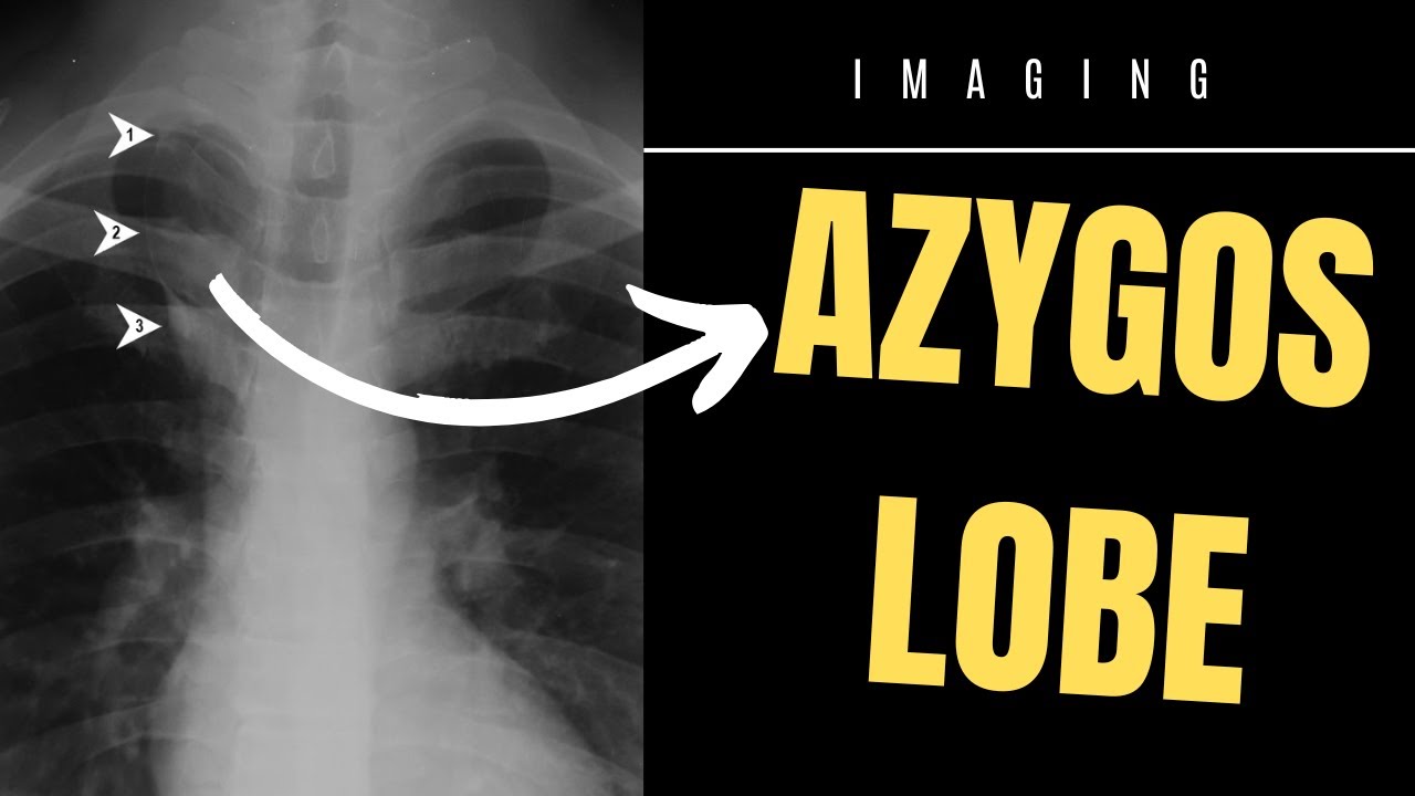 Azygos lobe 🫁 Anatomy - IN THREE 3️⃣ MINUTES ⌚