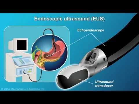 Understanding EUS-FNA