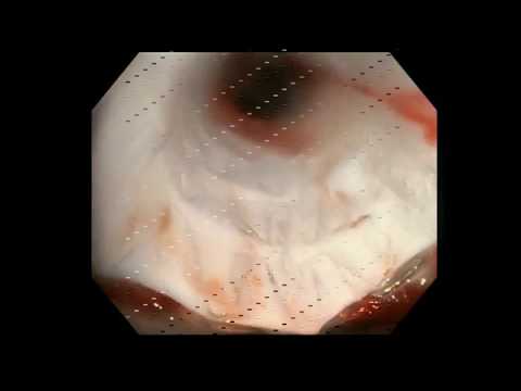 iCAST Stent through another iCAST Stent using Bifurcating Approach