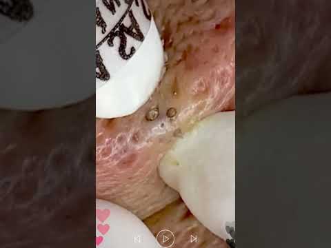 Skincare | Blackheads Removal #494 #tweezers skincare #blackheads blackheads