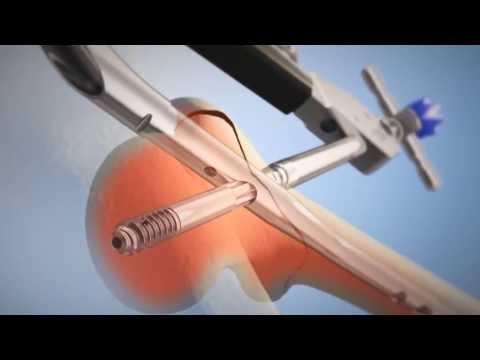 DLT™ Nail (by U&I CORPORATION)