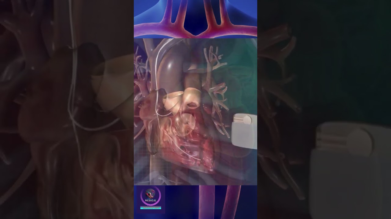 How a Pacemaker Works #shorts #education