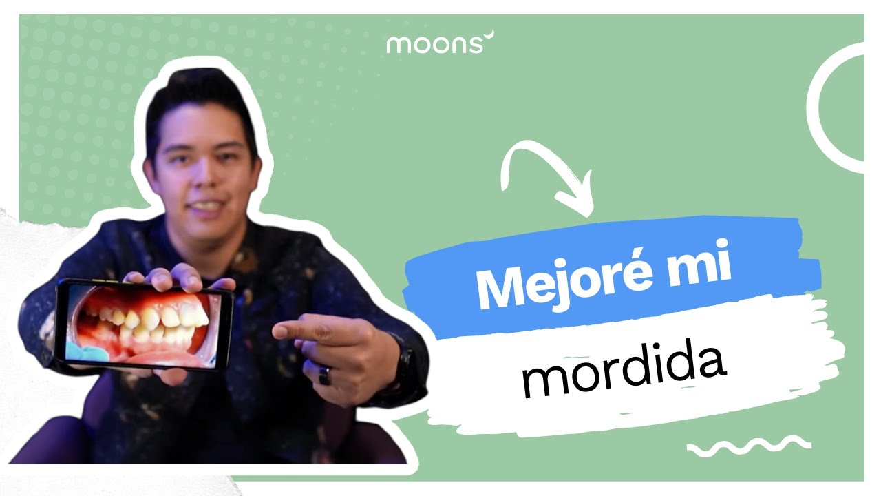 Resultados del tratamiento de ortodoncia sin brackets Moons