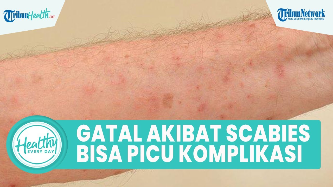 Waspadai Rasa Gatal akibat Scabies Bisa Picu Komplikasi, Begini Cara Atasi ala dr. Hari Purwanto ...