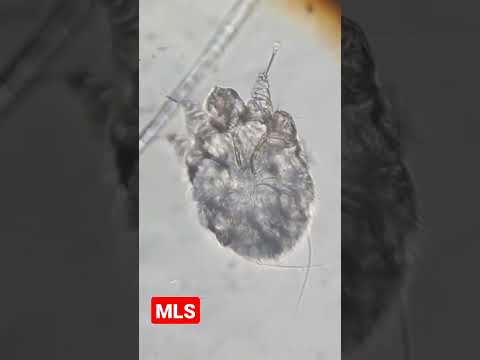 #skin #diagnosis showing Sarcoptes scabiei or the itch mite.