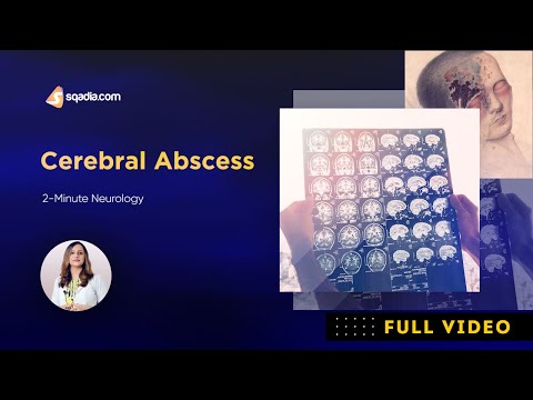 Cerebral Abscess Pathophysiology | 2-Minute Neurology Video | V-Learning™