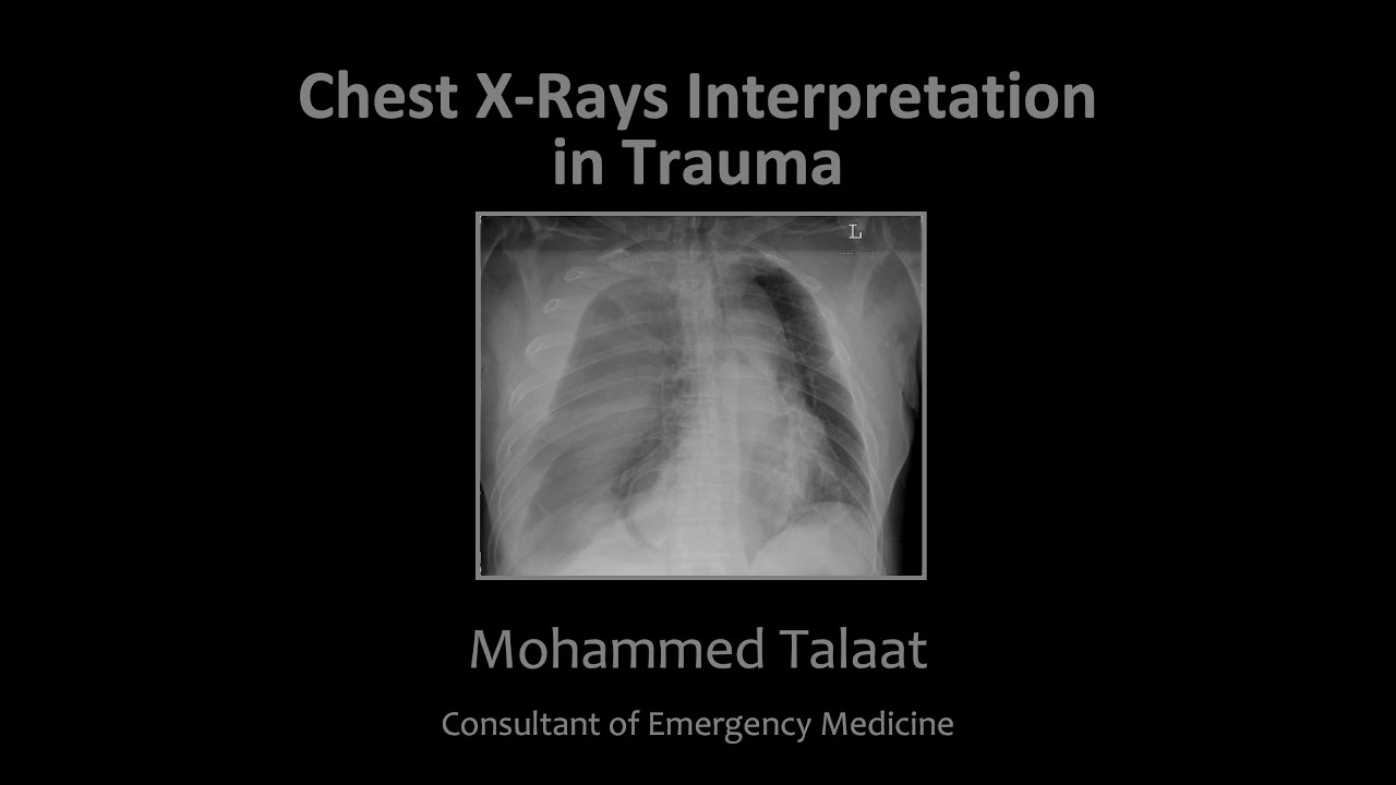 Chest X Rays Interpretation in Trauma