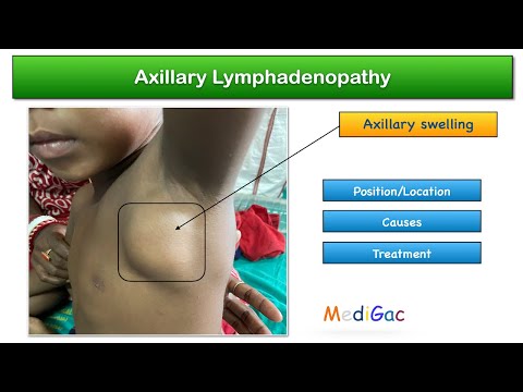 Axillary lymphadenopathy - Location & Position | Causes | Treatment