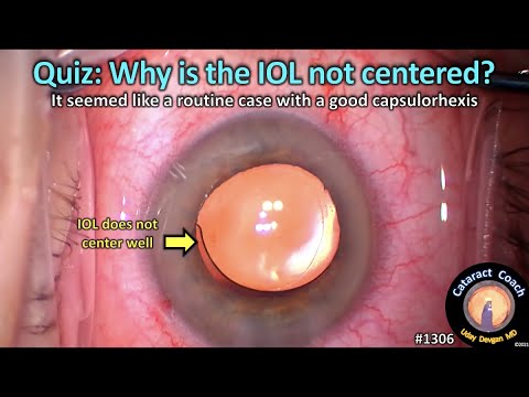 CataractCoach 1306: Cataract Quiz: why is the IOL not centered?