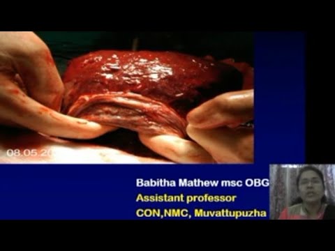 uterine inversion/causes/degrees/ signs and symptoms/management/complication and prevention