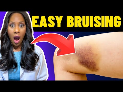 EASY BRUISING? THIS COULD BE WHY! Plus, How to Heal a Bruise, Different Color Bruises & More