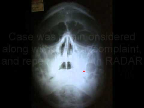 Sinusitis Cured By Homeopathy Dr Ravi Singh