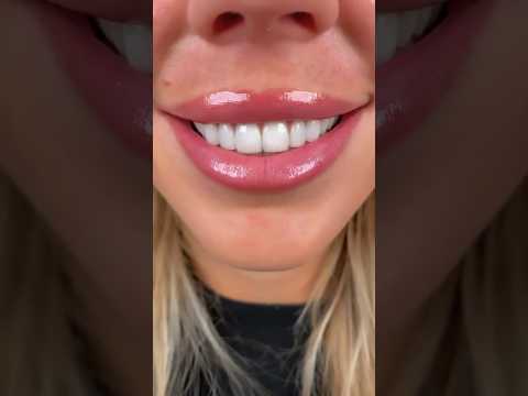 Which one is your favorite? #veneers #dentist #biomimeticdentistry