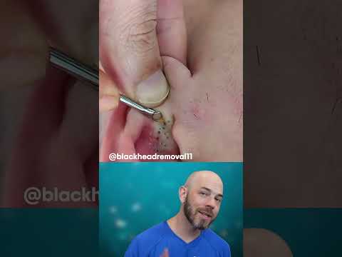 Blackheads galore in this ear!👂(credit: @blackheadremoval1 on TT) #satisfying #blackheads