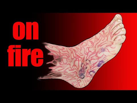 How is CRPS Diagnosed? What is the Budapest Criteria?