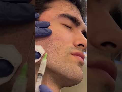 Acne scar treatment