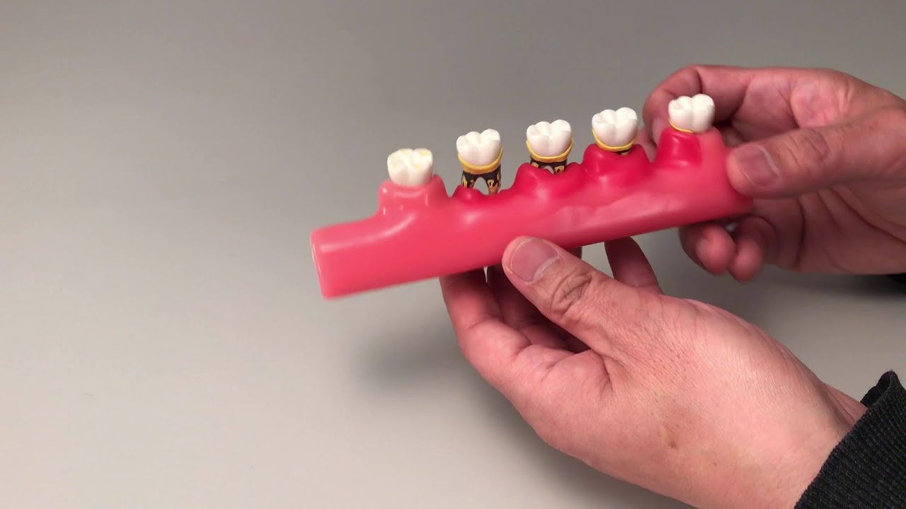 PERIO MODEL w/ TOOTH MOBILITY 2