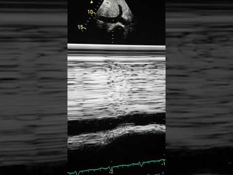 Dilated cardiomyopathy Non ischemic