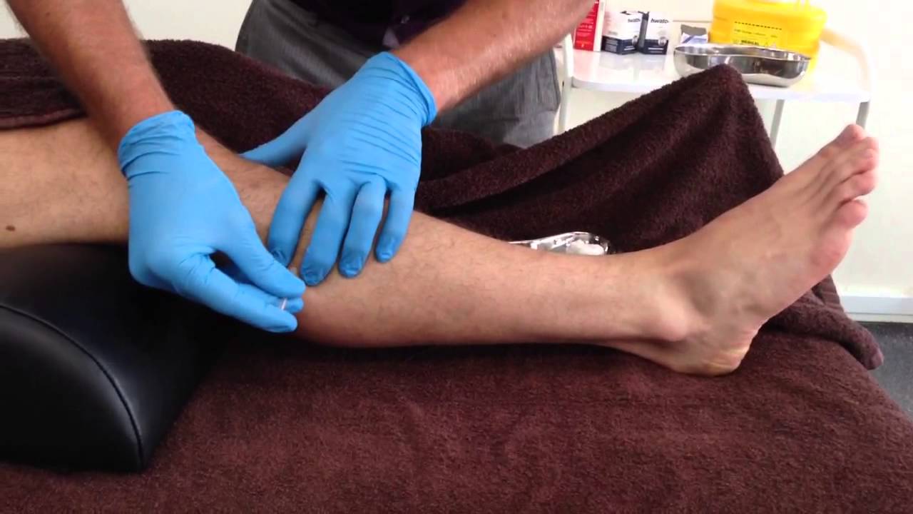 Dry Needling: Peroneus Longus & Brevis