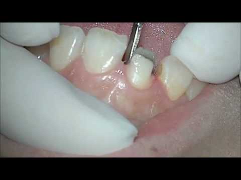 Ceramic Teeth - ceramic crown Latest Price, Manufacturers & Suppliers