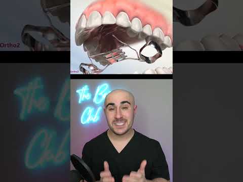 Braces Expander Explained #shorts