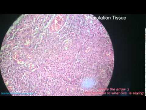 pathochap3 granulation tissue xvid