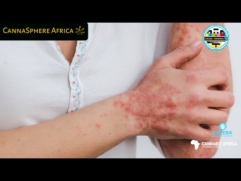 Psoriasis and Cannabis topicals as a treatment - CannaSphere Shorts