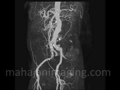 CT Angiogram of the abdomen