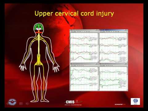 "Patient Transparent" Intraoperative Neurophysiological Monitoring in MISS