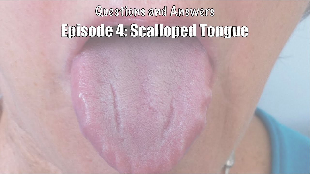 Question 4: What Causes Tongue Scalloping?