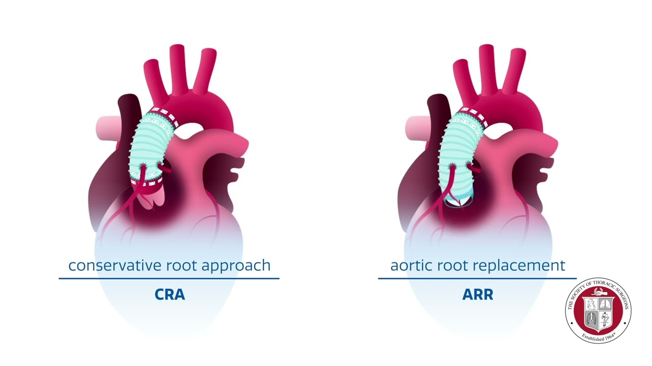 The Aortic Root in ATAAD: Repair or Replace? | Annals Animated (June 2023)