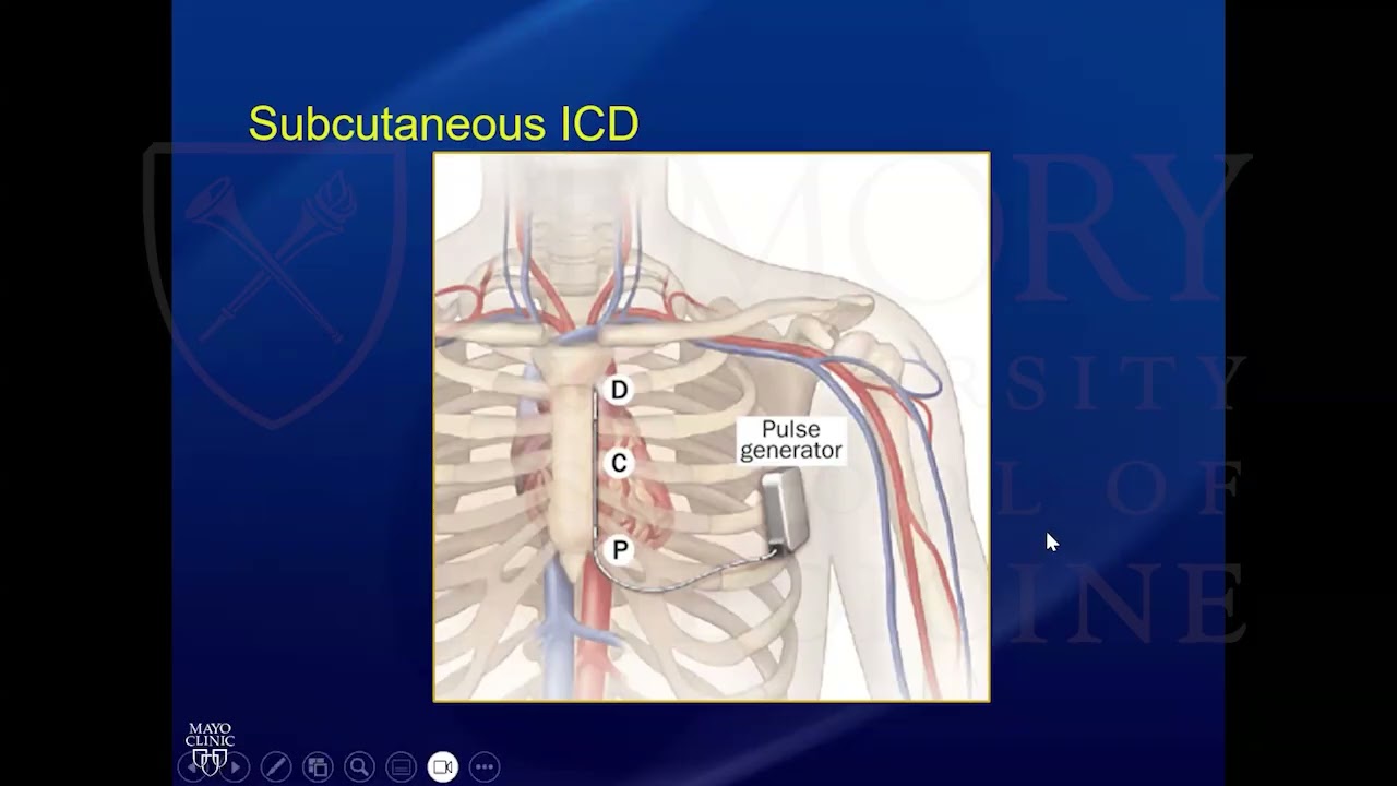 Ablation for Ventricular Fibrillation