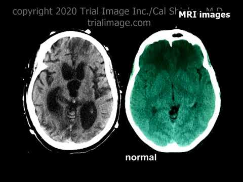 Hydrocephalus due to Colloid Cyst Animation by Cal Shipley, M.D.