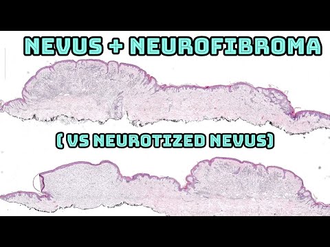 Nevus + Neurofibroma (vs neurotized nevus) pathology dermpath dermatology dermatopathology