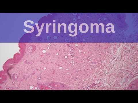 What is a Syringoma? - Pathology mini tutorial