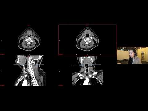 Parathyroid - Eutopic Inferior Location Pt. 3