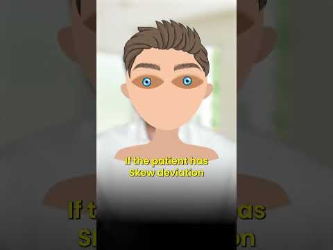 Central vs peripheral vertigo