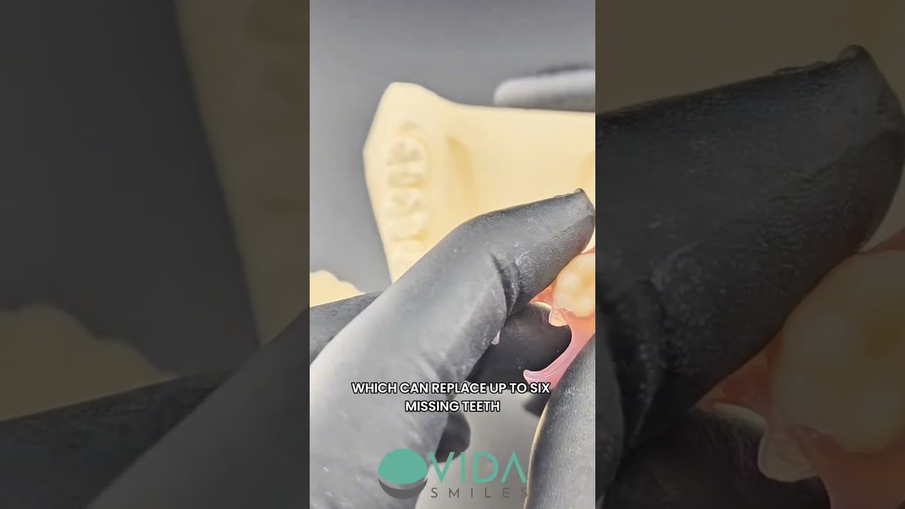 Flexible Partial Denture